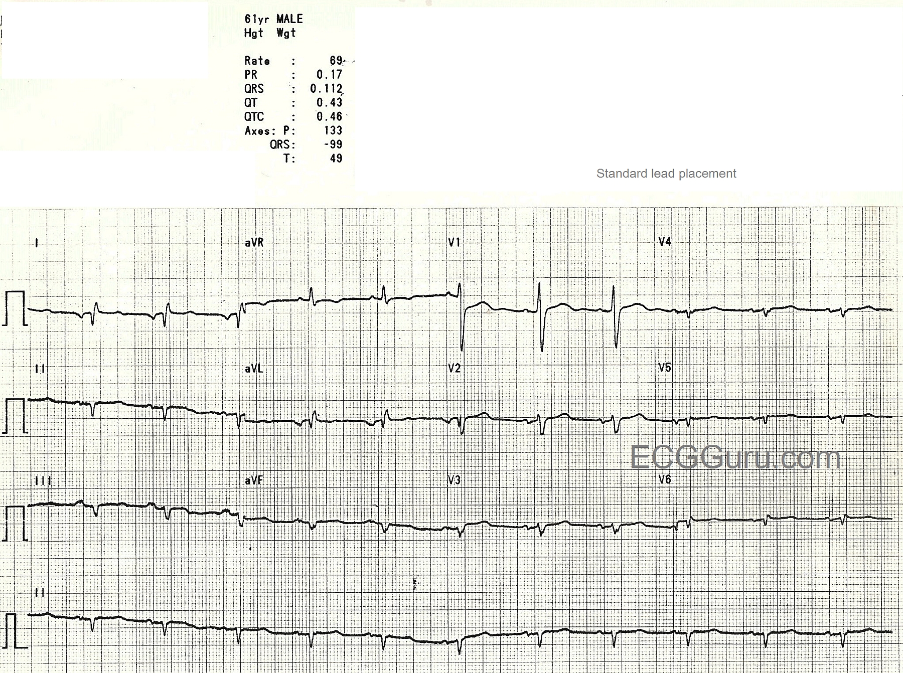 Dextrocardia | ECG Guru - Instructor Resources Dextrocardia | ECG Guru - Instructor Resources